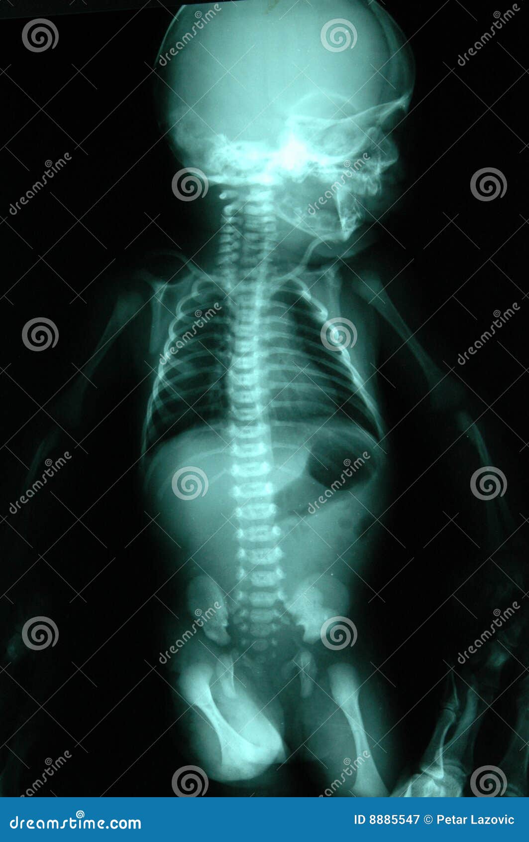Black and green x-ray film stock image. Image of radiological - 8885547
