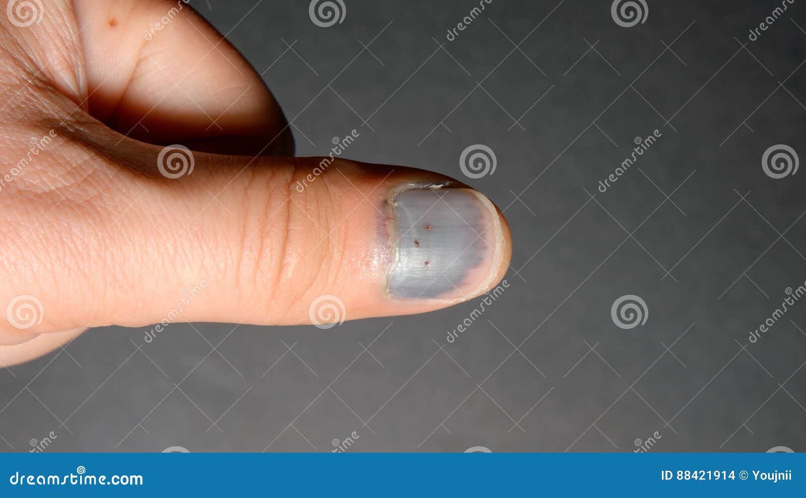 Blackened Nail of Hand - Left Stock Photo - Image of unpleasant ...