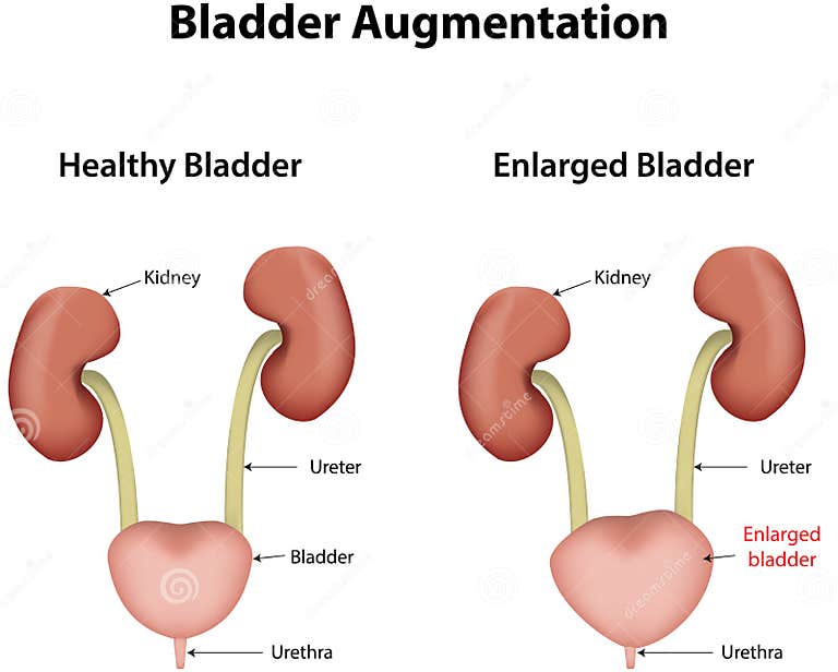 Bladder Augmentation Labeled Diagram Stock Vector - Illustration of ...