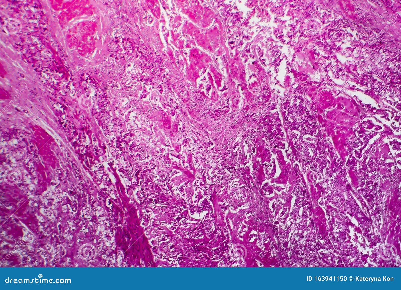 Bladder Cancer, Light Micrograph Stock Photo - Image of histopathology ...