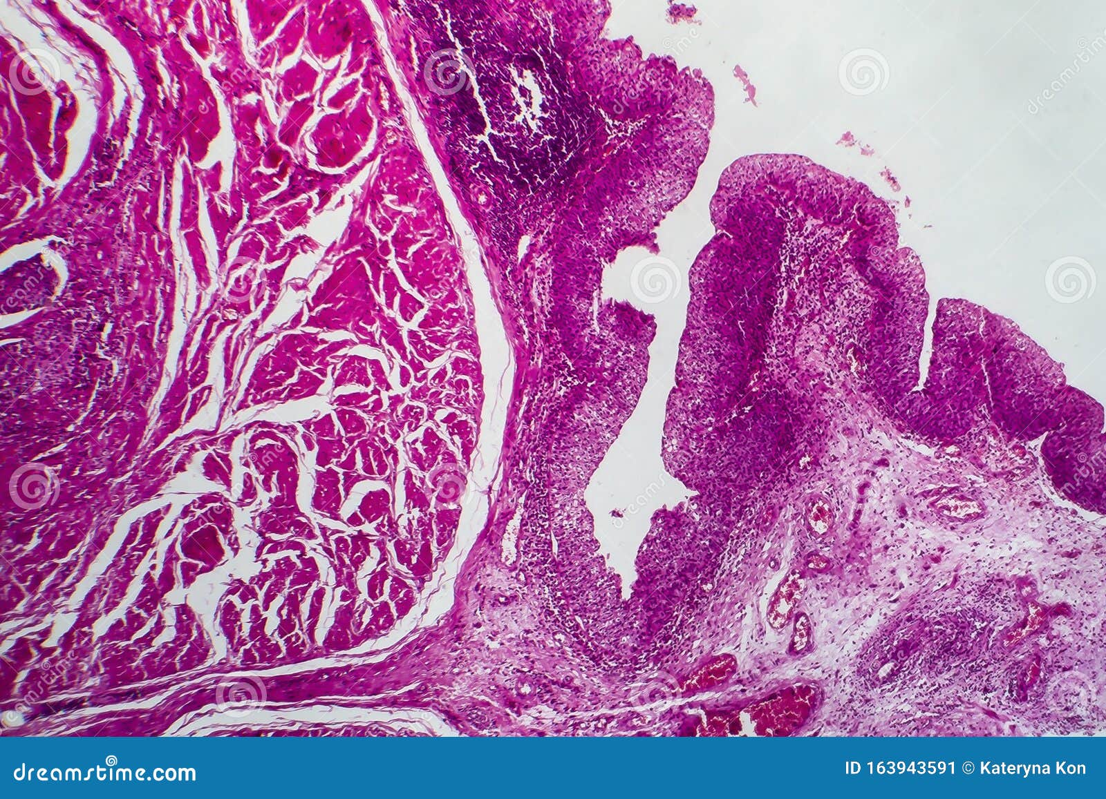 Bladder Cancer, Light Micrograph Stock Image - Image of photomicrograph ...