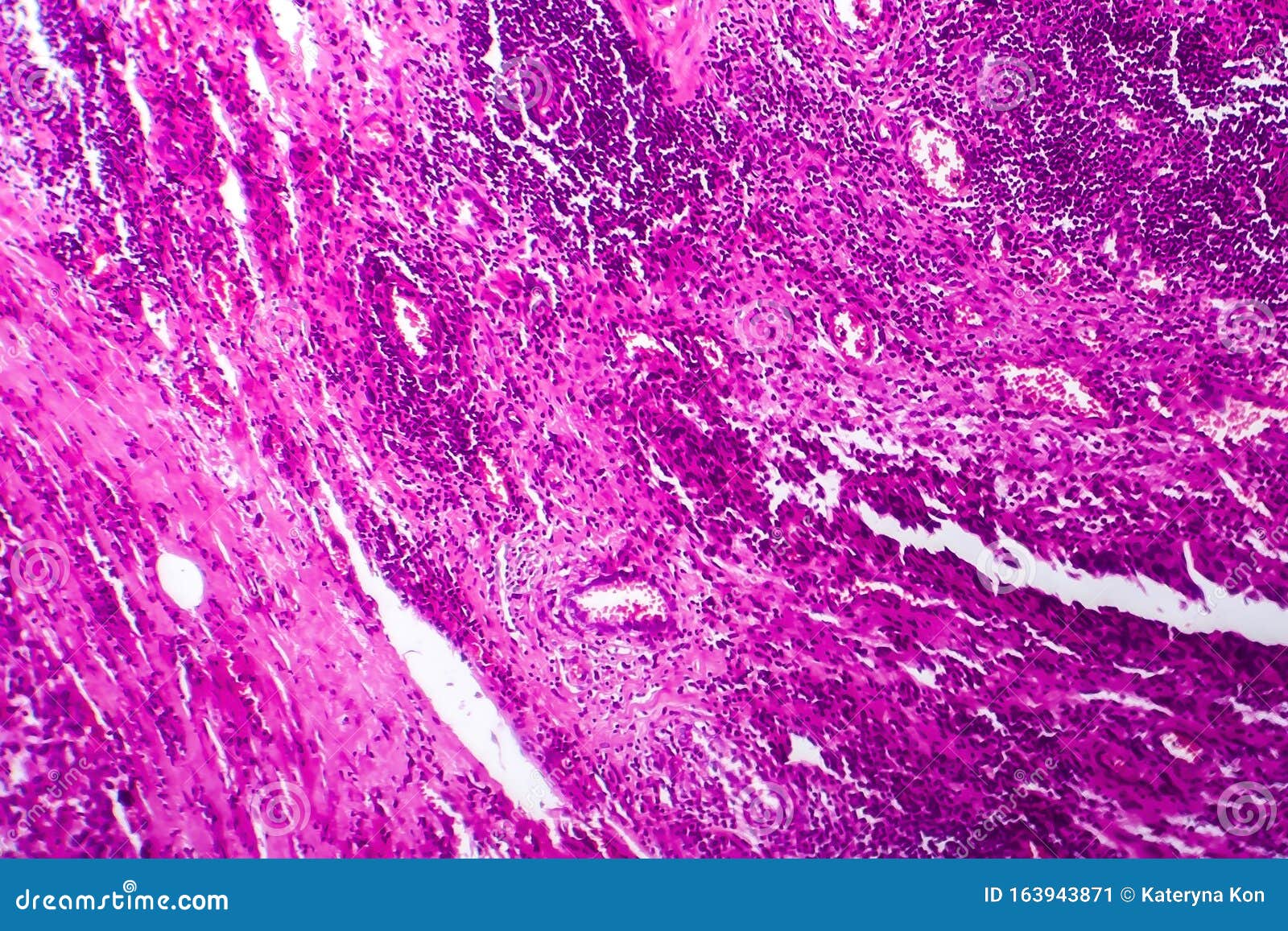 Bladder Cancer, Light Micrograph Stock Image - Image of micro, cell ...