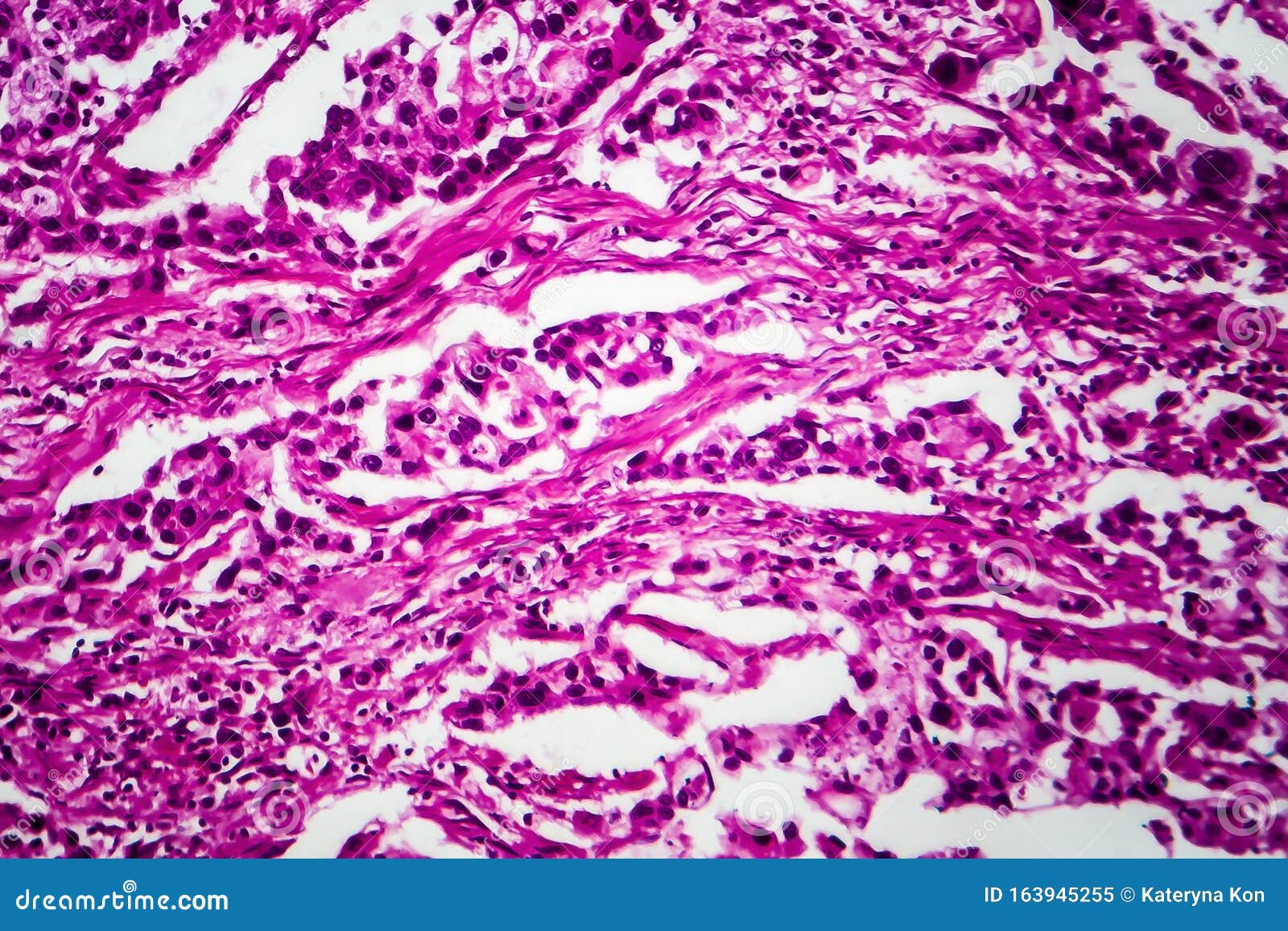 Bladder Cancer, Light Micrograph Stock Image - Image of cell, carcinoma ...