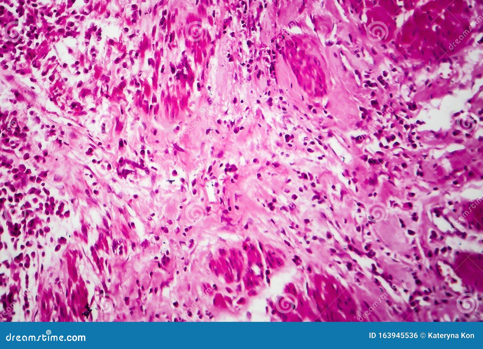 Bladder Cancer, Light Micrograph Stock Photo - Image of genitourinary ...