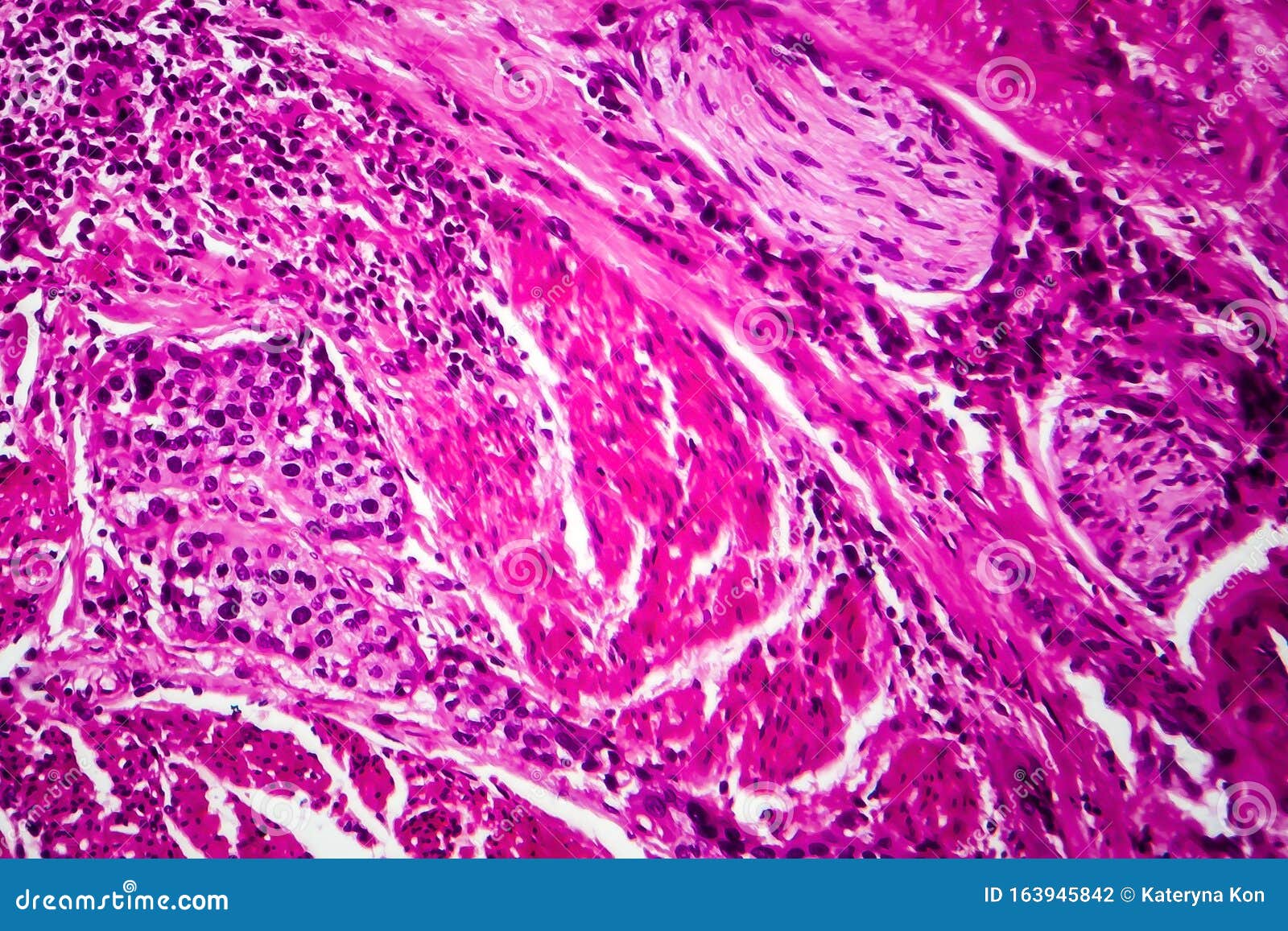 Bladder Cancer, Light Micrograph Stock Photo - Image of medical ...