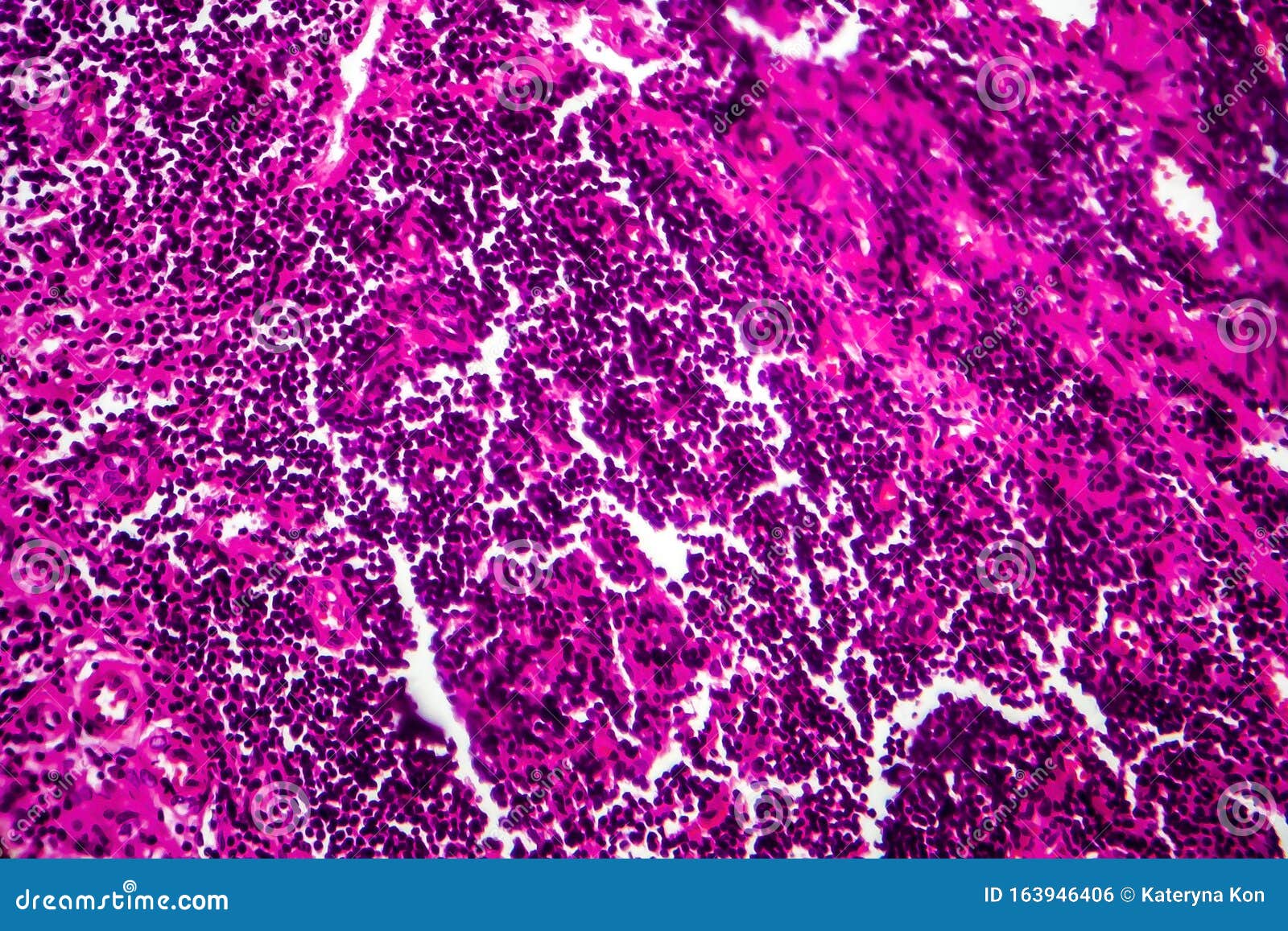 Bladder Cancer, Light Micrograph Stock Photo - Image of bladder ...