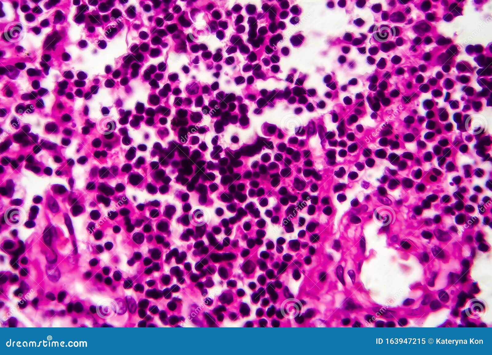 Bladder Cancer, Light Micrograph Stock Image - Image of microscopy ...