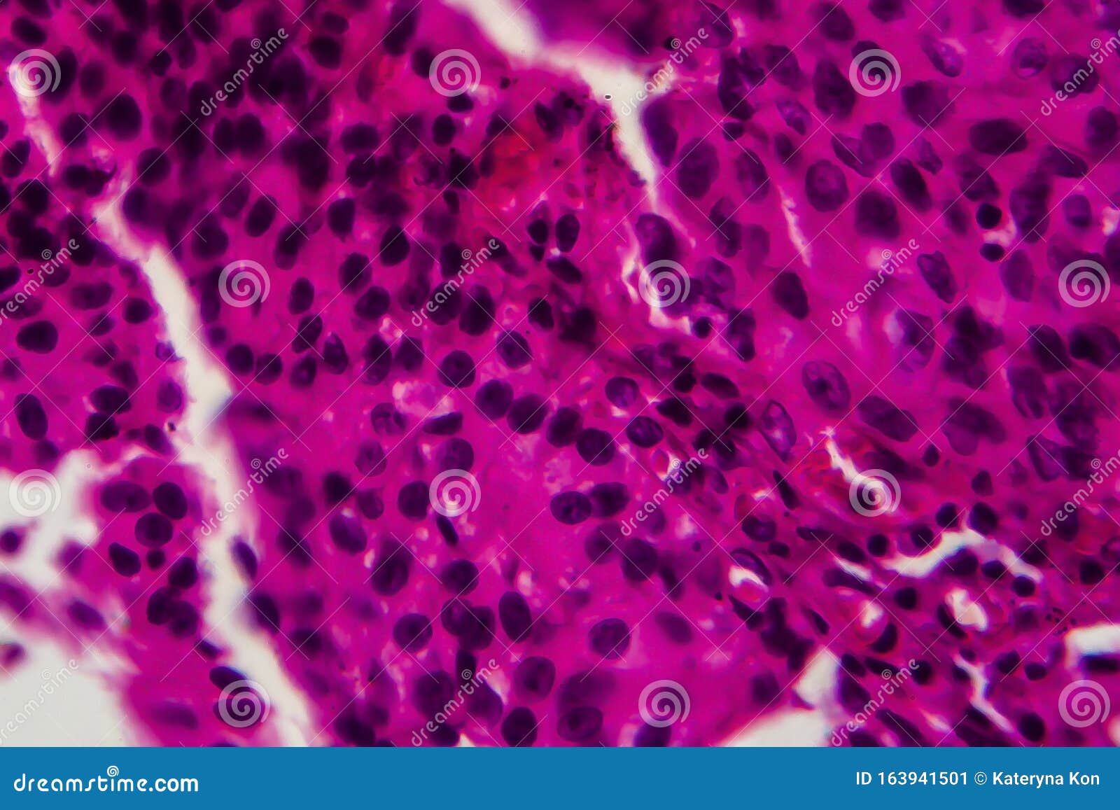 Bladder Cancer, Light Micrograph Stock Image - Image of hematoxylin ...