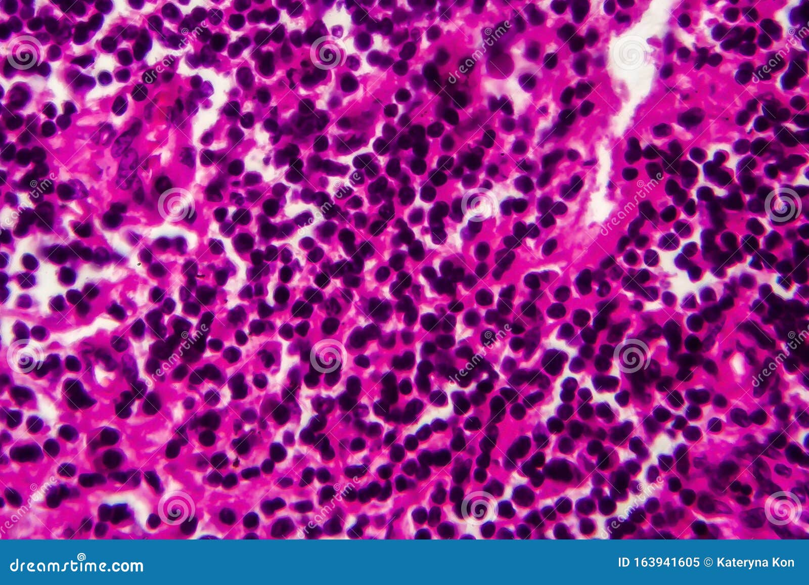 Bladder Cancer, Light Micrograph Stock Image - Image of morphology ...