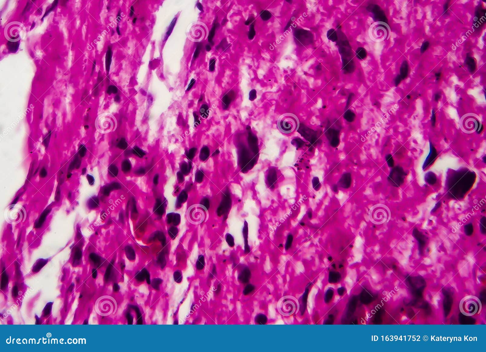 Bladder Cancer, Light Micrograph Stock Photo - Image of malignant ...