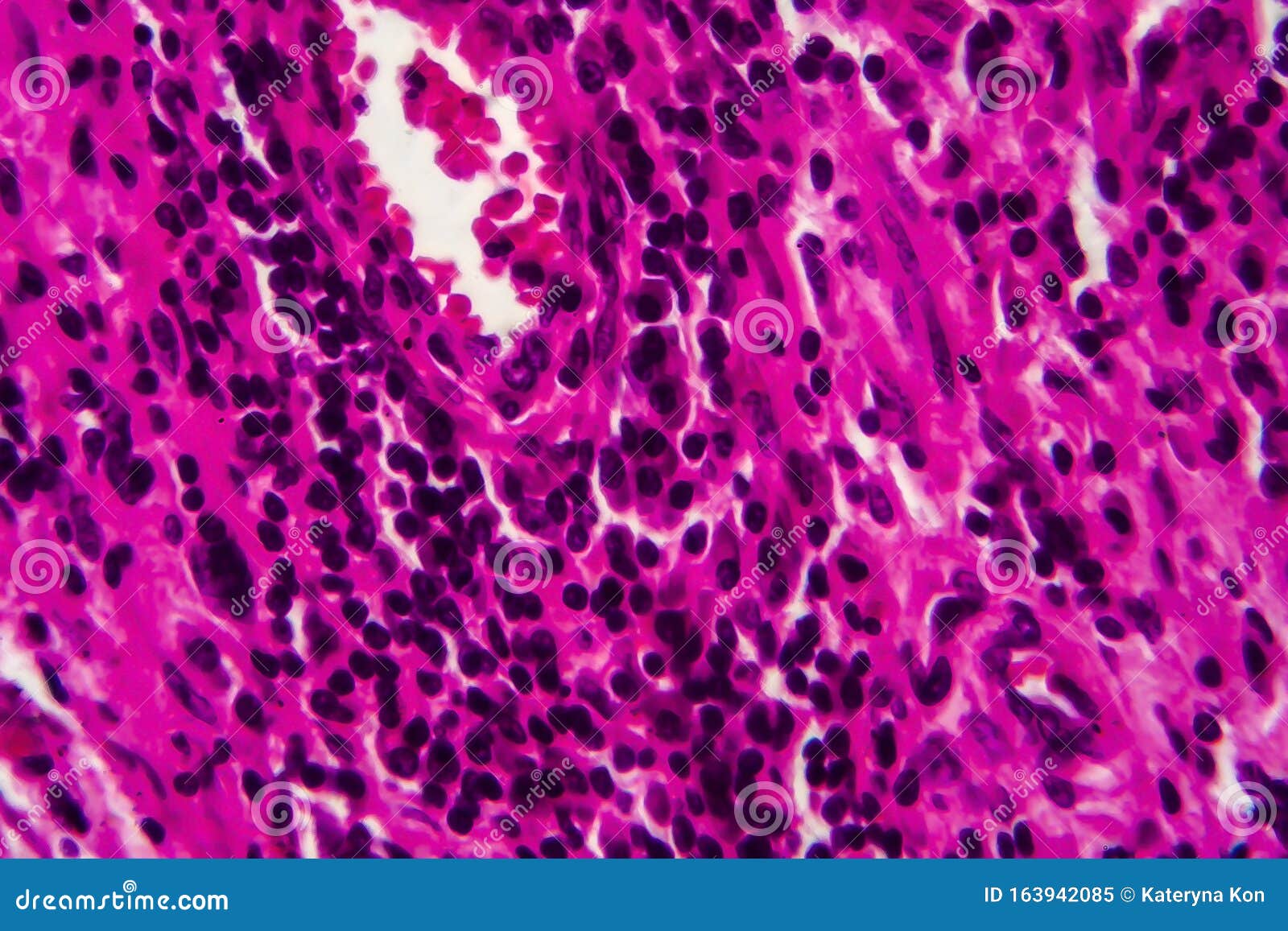 Bladder Cancer, Light Micrograph Stock Image - Image of histology ...