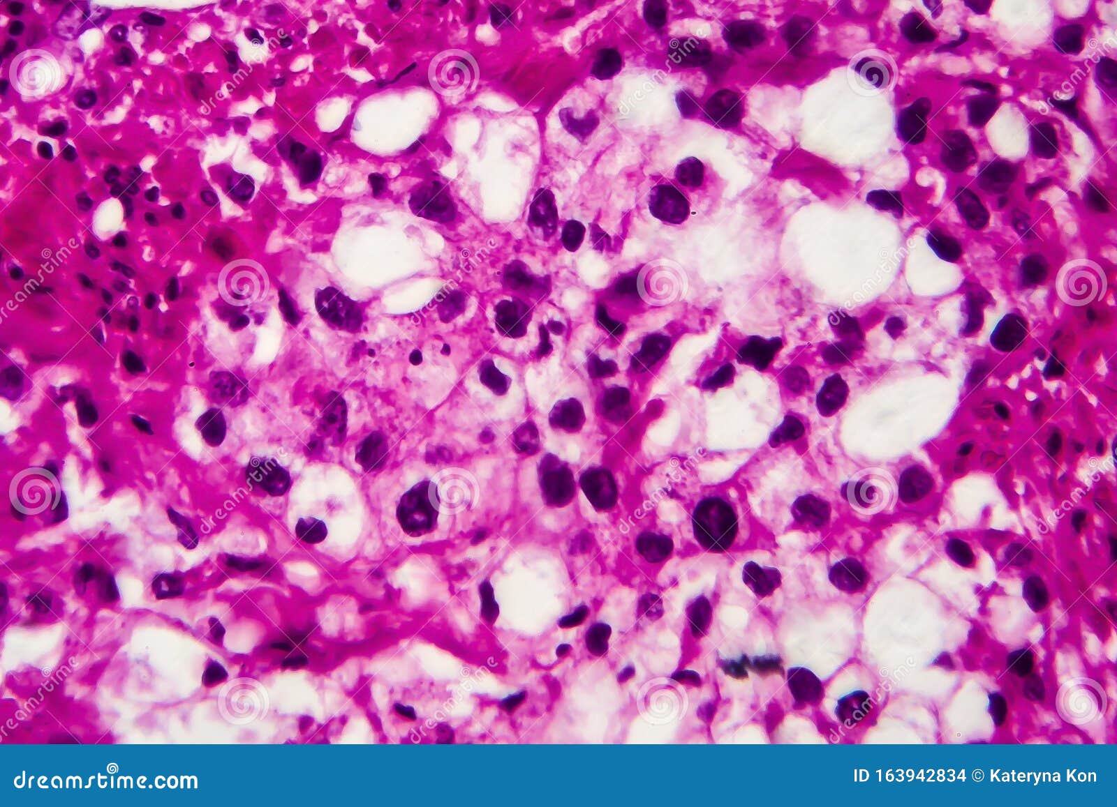 Bladder Cancer, Light Micrograph Stock Photo - Image of neoplasm ...