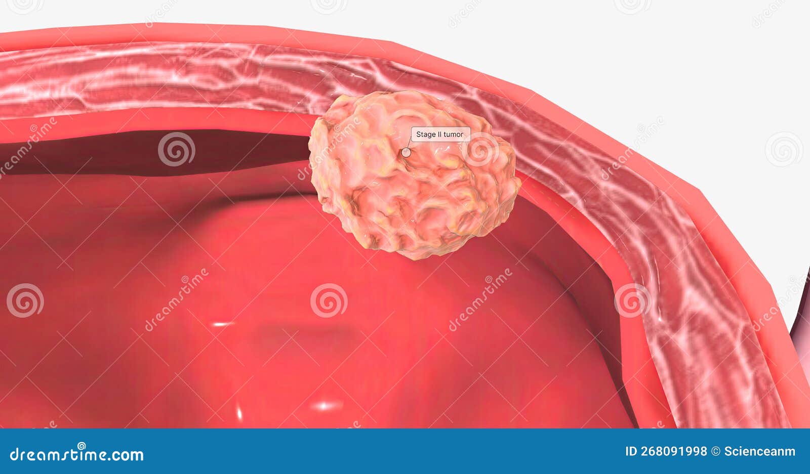 The Bladder Cancer, Stage II Stock Illustration - Illustration of ...