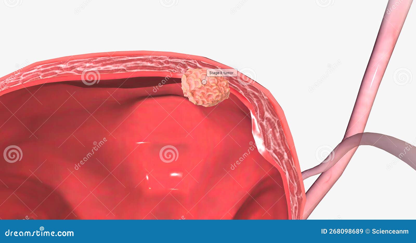 The Bladder Cancer, Stage II Stock Illustration - Illustration of ...