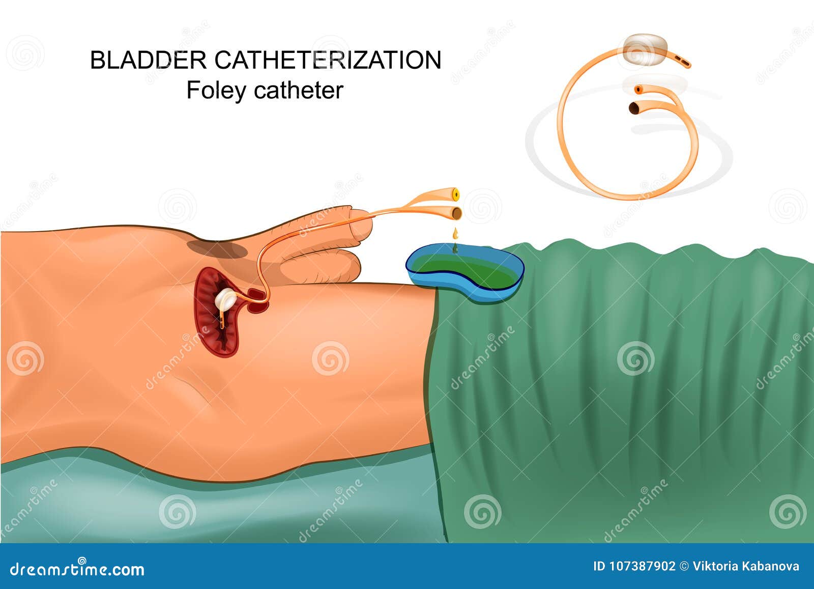 Bladder Catheterization with a Foley Catheter Stock Vector ...