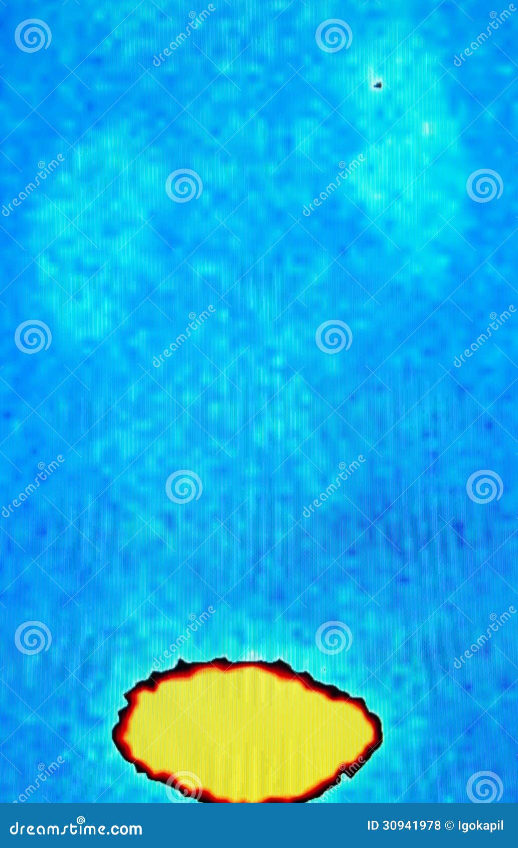 Bladder, nuclear medicine stock photo. Image of bladder - 30941978