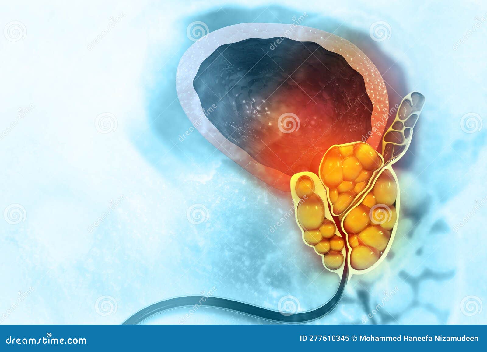 Bladder Stones. Cross Section Stock Illustration - Illustration of ...