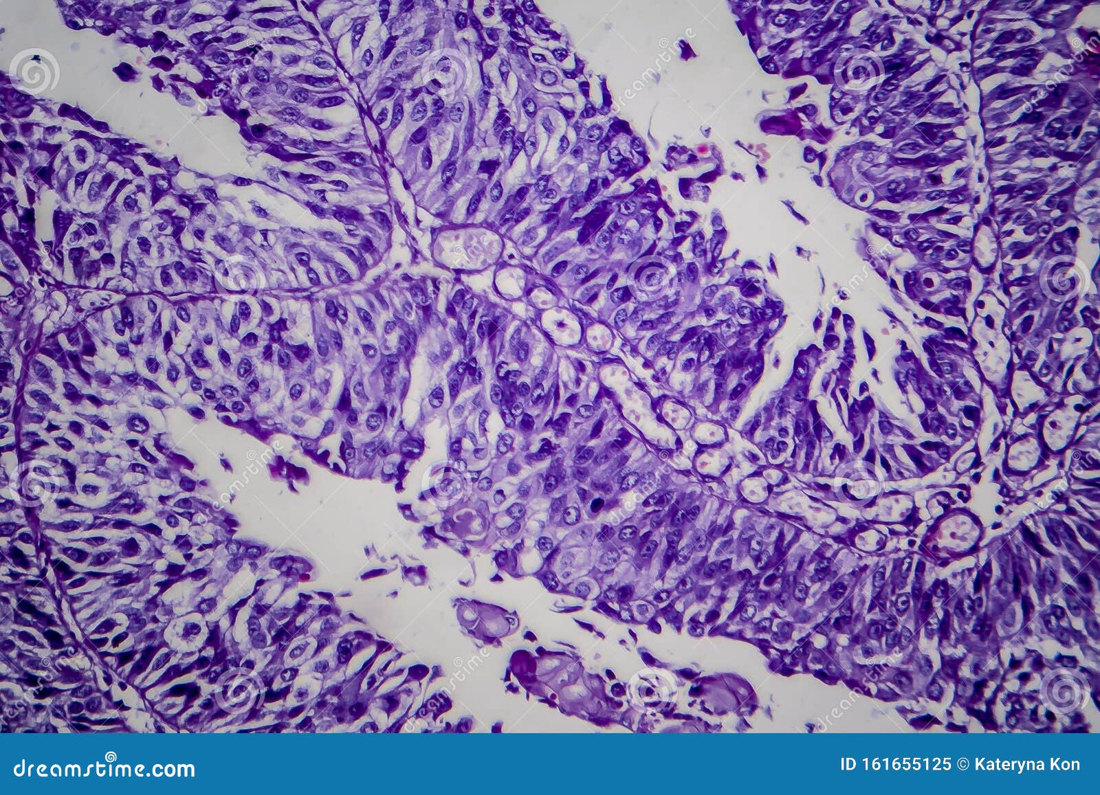 Transitional Cell Carcinoma