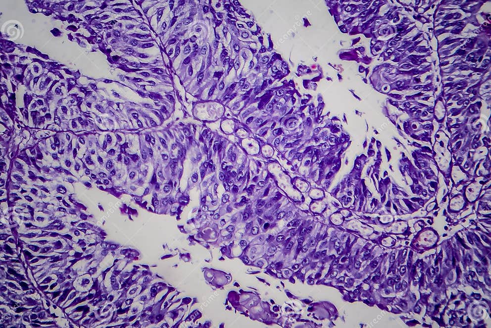 Bladder Transitional Cell Carcinoma, Light Micrograph Stock Image ...