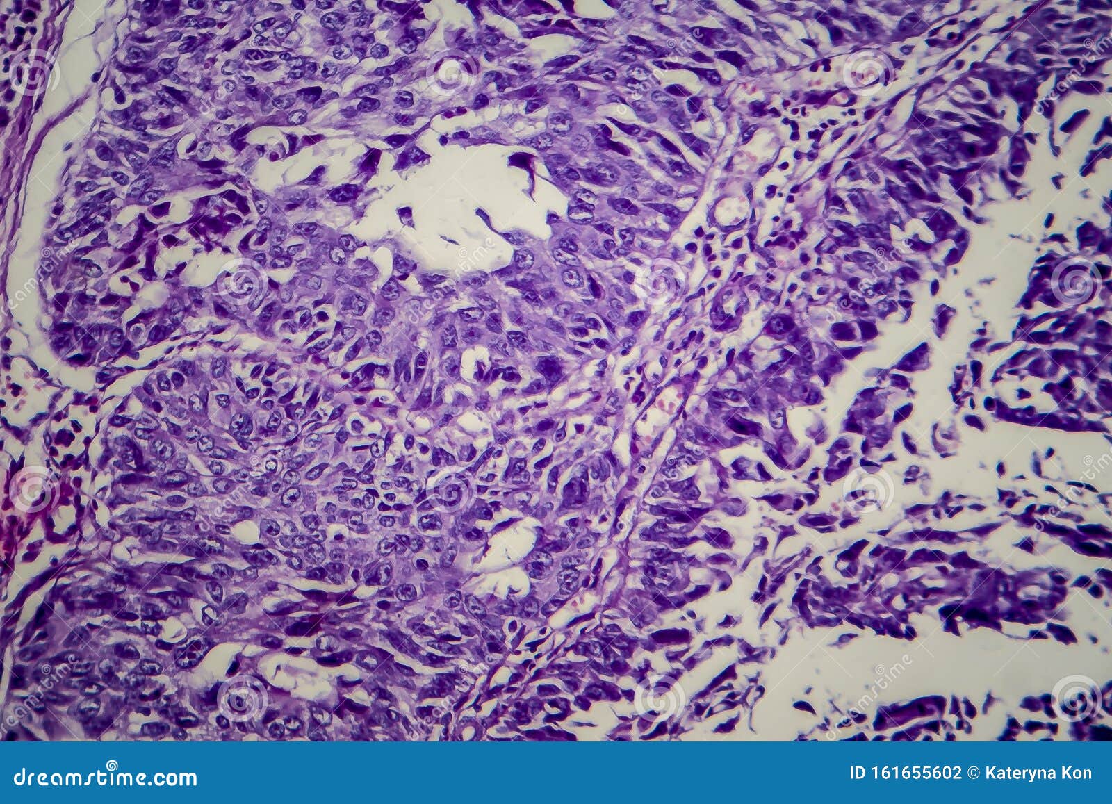 Bladder Transitional Cell Carcinoma, Light Micrograph Stock Photo ...