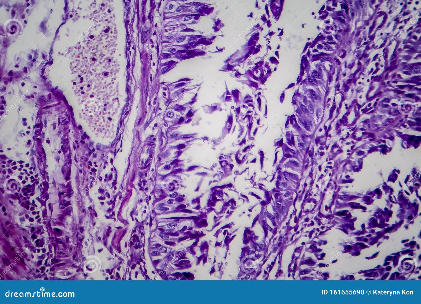 Bladder Transitional Cell Carcinoma, Light Micrograph Stock Photo ...