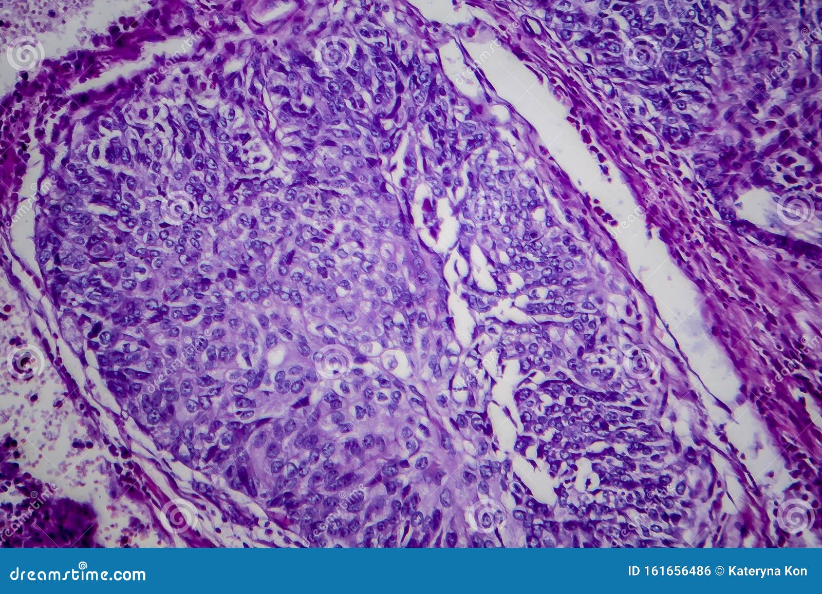 Bladder Transitional Cell Carcinoma, Light Micrograph Stock Photo ...
