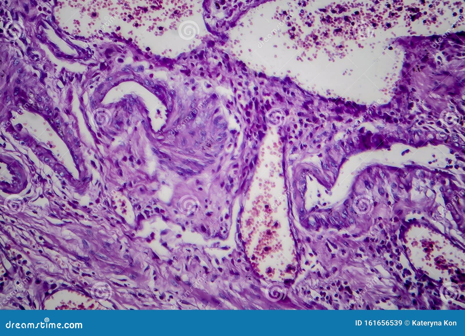 Bladder Transitional Cell Carcinoma, Light Micrograph Stock Image ...