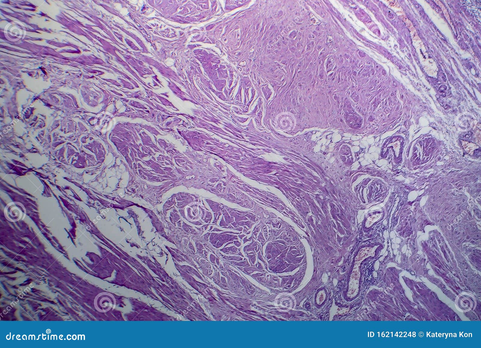 Bladder Transitional Cell Carcinoma, Light Micrograph Stock Photo ...