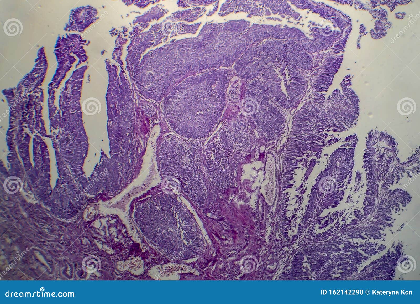 Bladder Transitional Cell Carcinoma, Light Micrograph Stock Photo ...