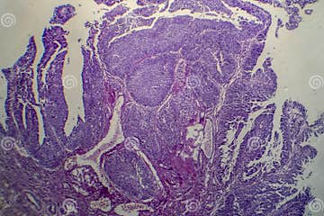 Bladder Transitional Cell Carcinoma, Light Micrograph Stock Photo ...