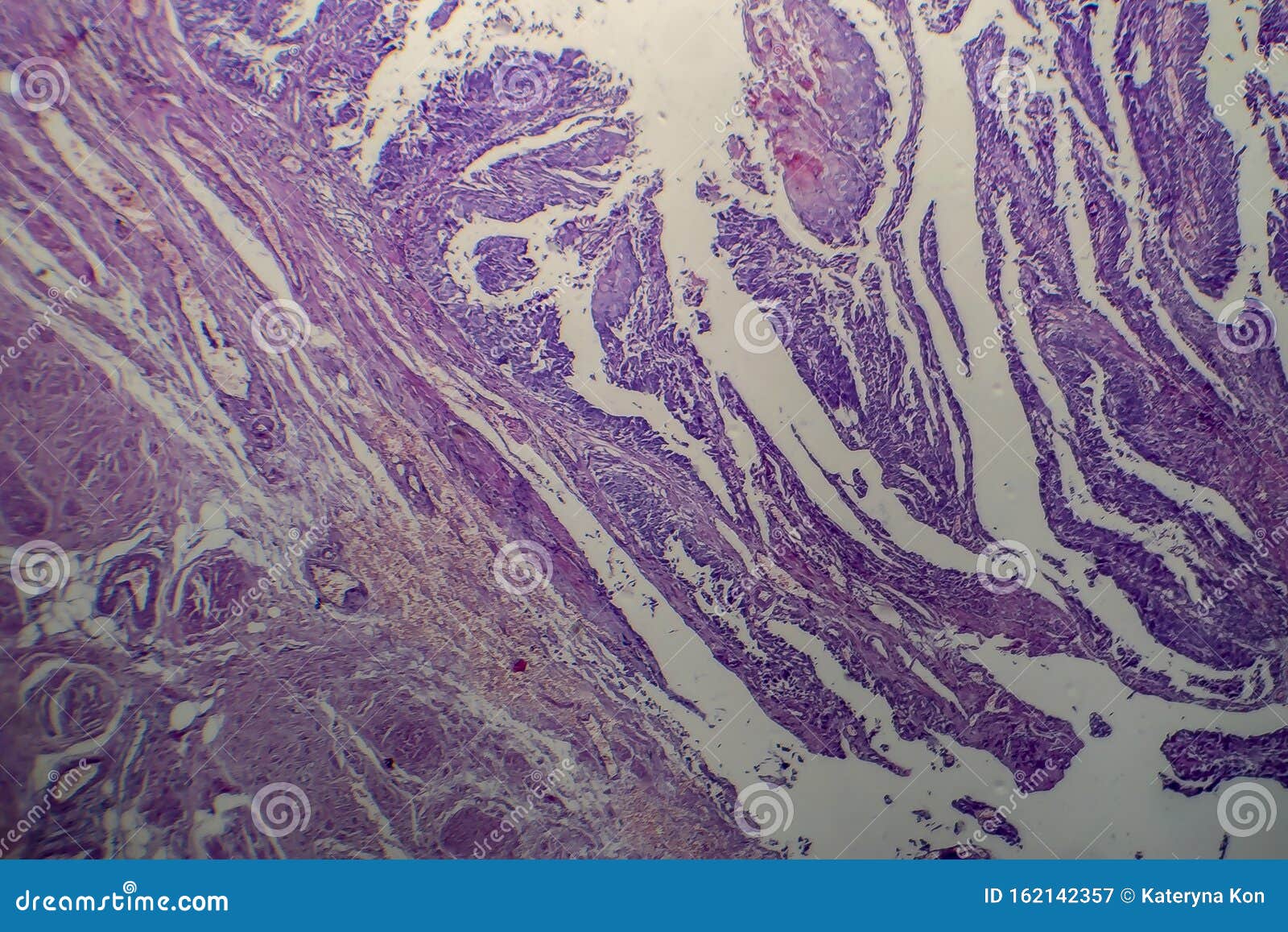 Bladder Transitional Cell Carcinoma, Light Micrograph Stock Image ...