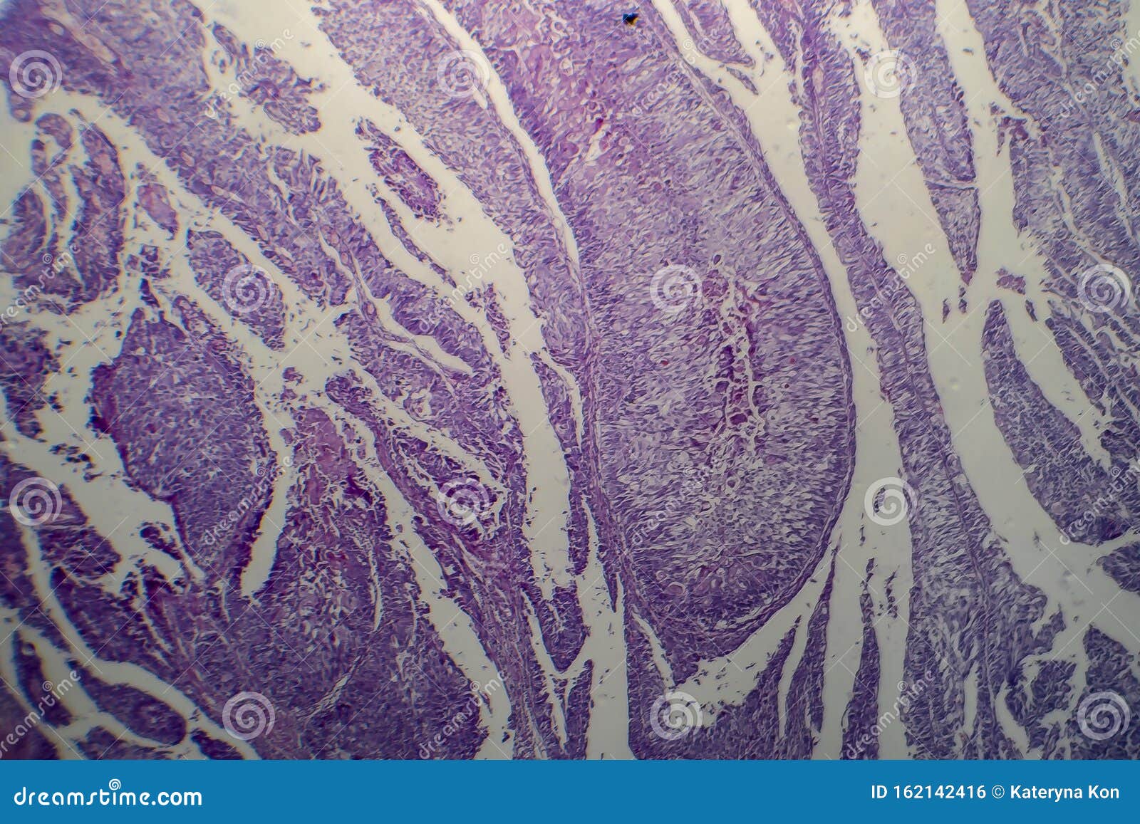 Bladder Transitional Cell Carcinoma, Light Micrograph Stock Photo ...