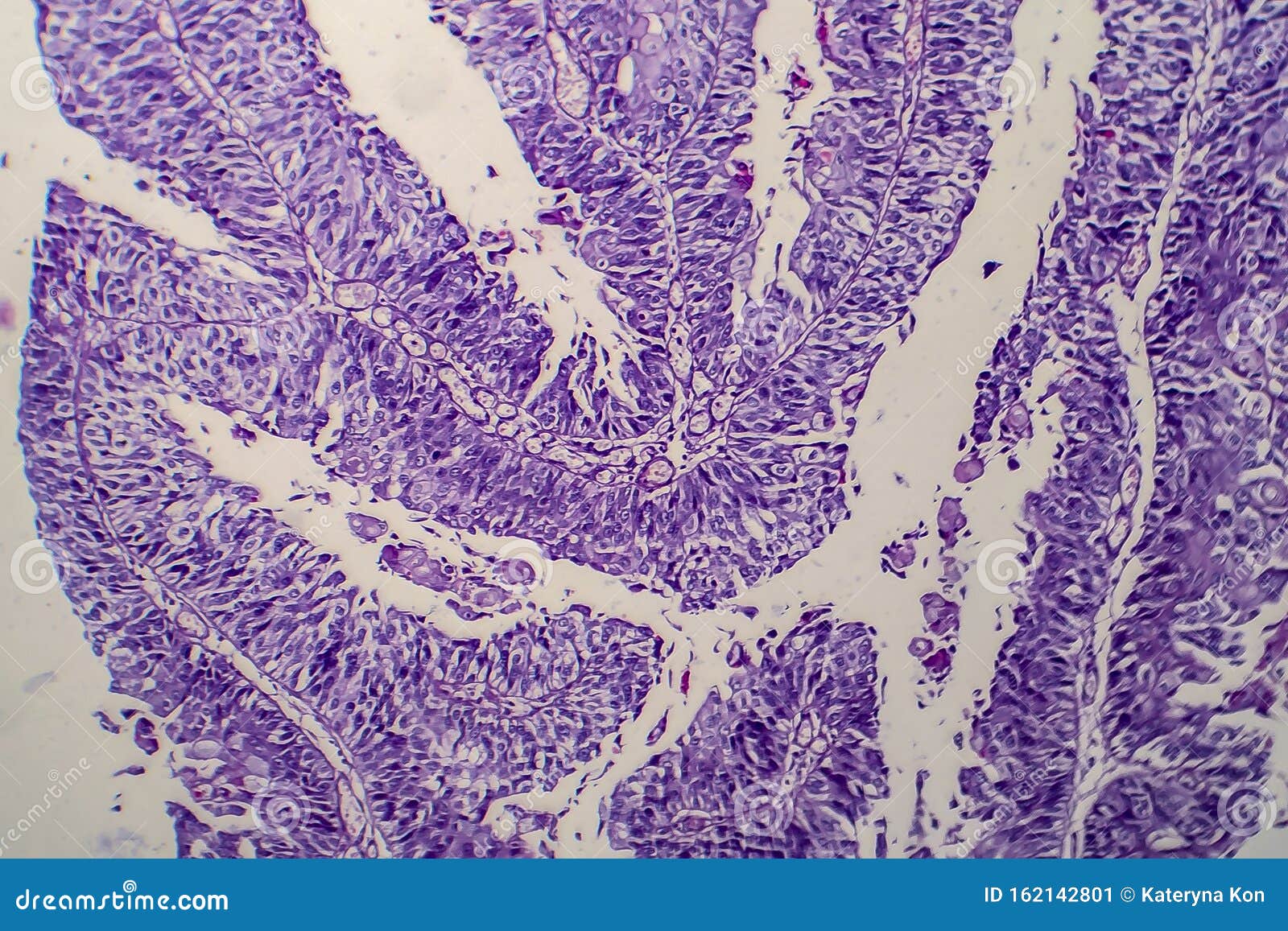 Transitional Cell Carcinoma