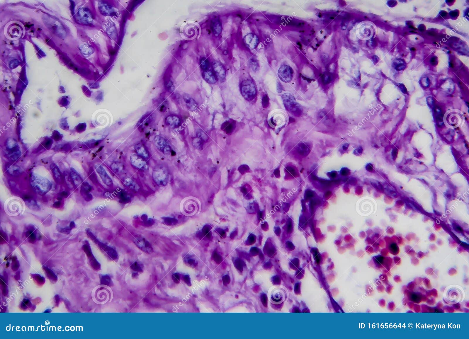 Transitional Cell Carcinoma