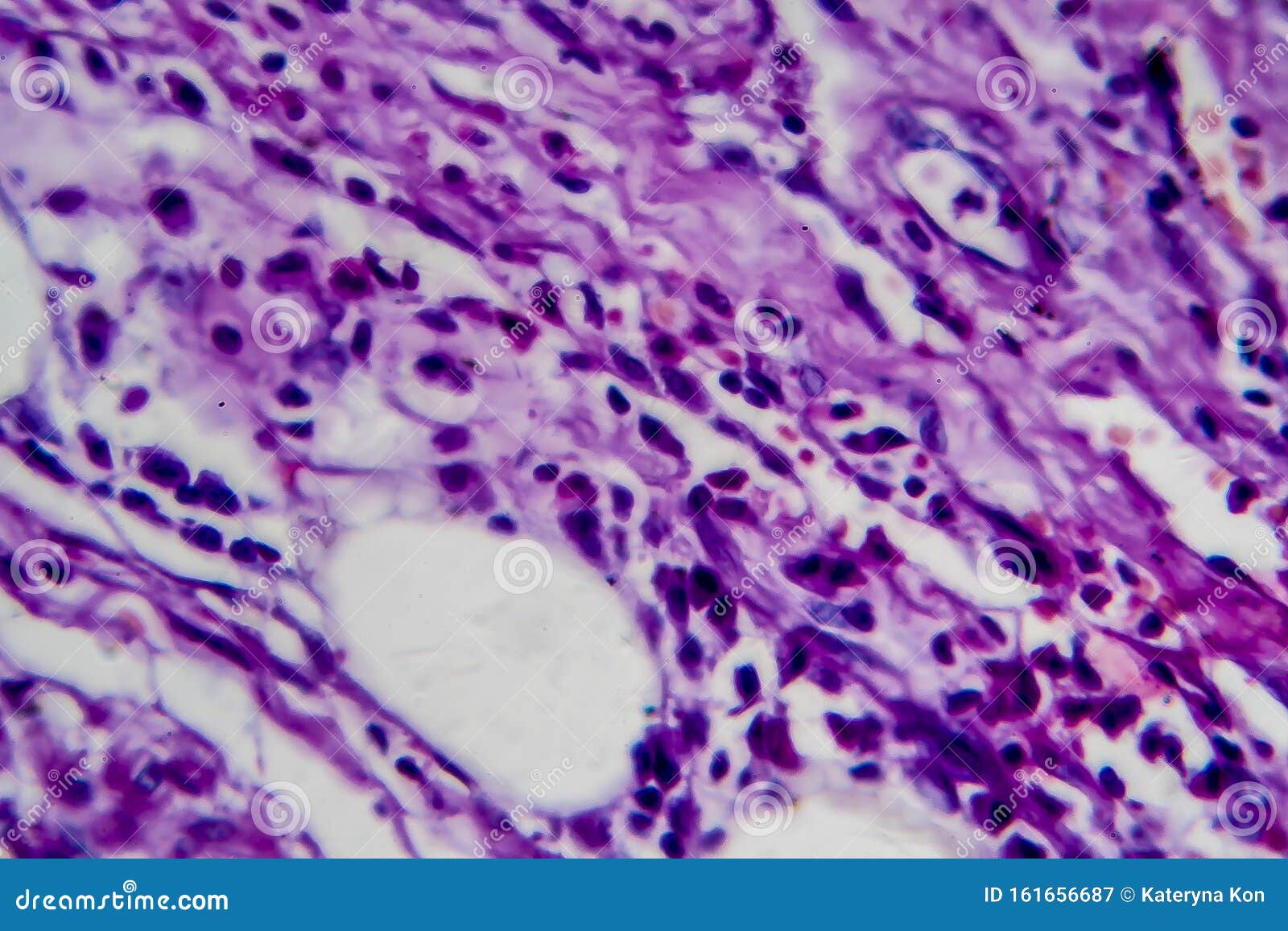 Bladder Transitional Cell Carcinoma, Light Micrograph Stock Image ...