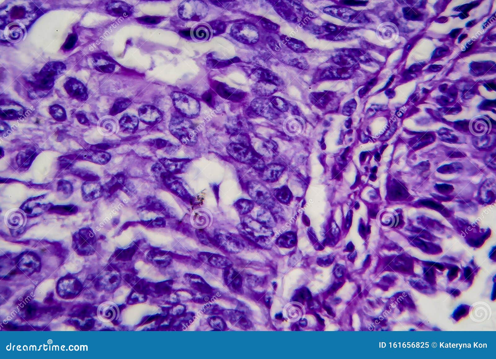 Transitional Cell Carcinoma
