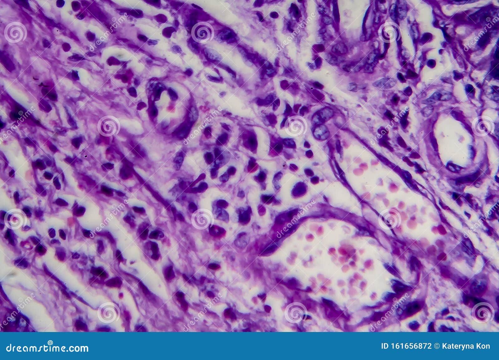 Bladder Transitional Cell Carcinoma, Light Micrograph Stock Photo ...