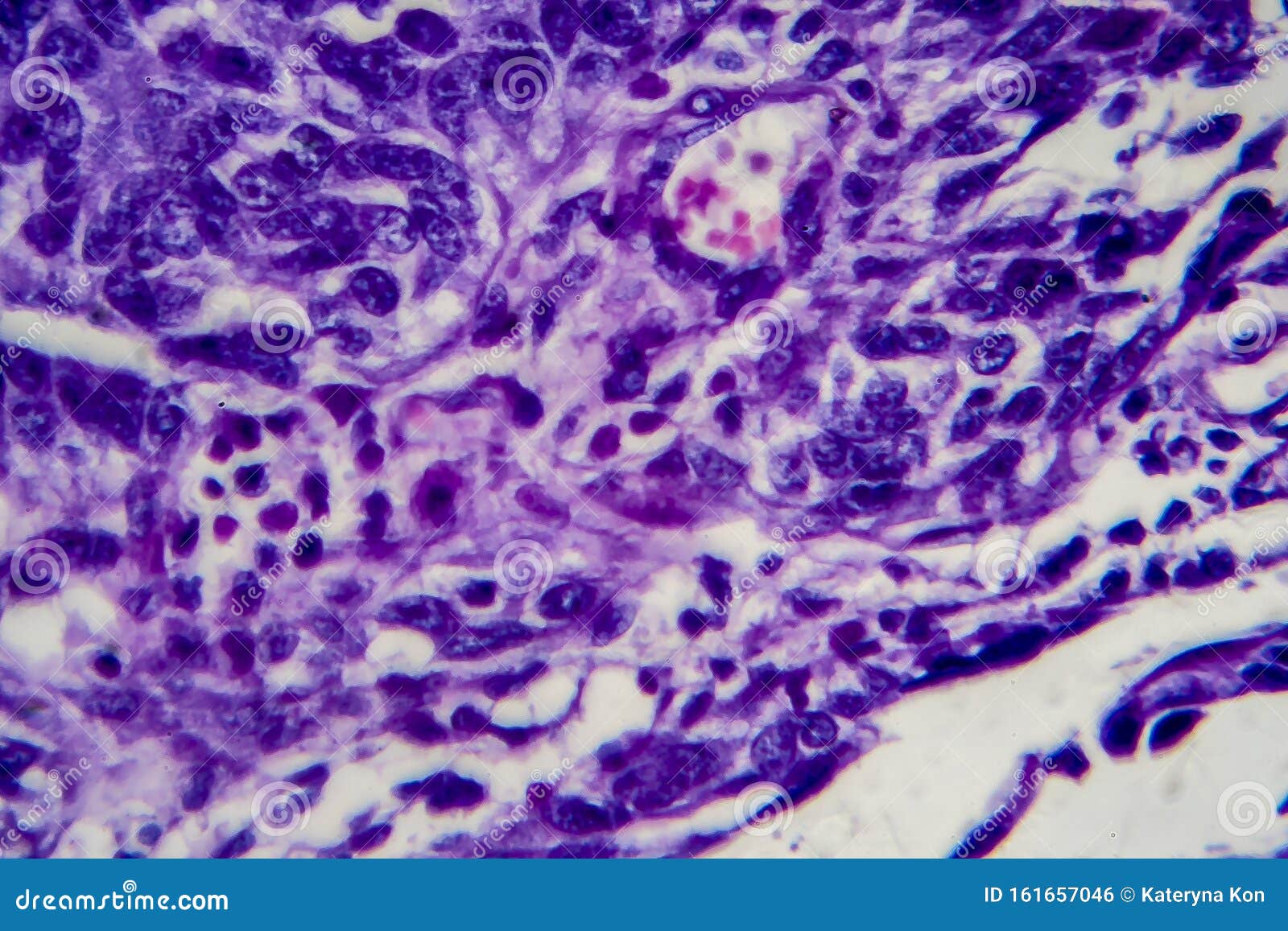 Bladder Transitional Cell Carcinoma, Light Micrograph Stock Photo ...