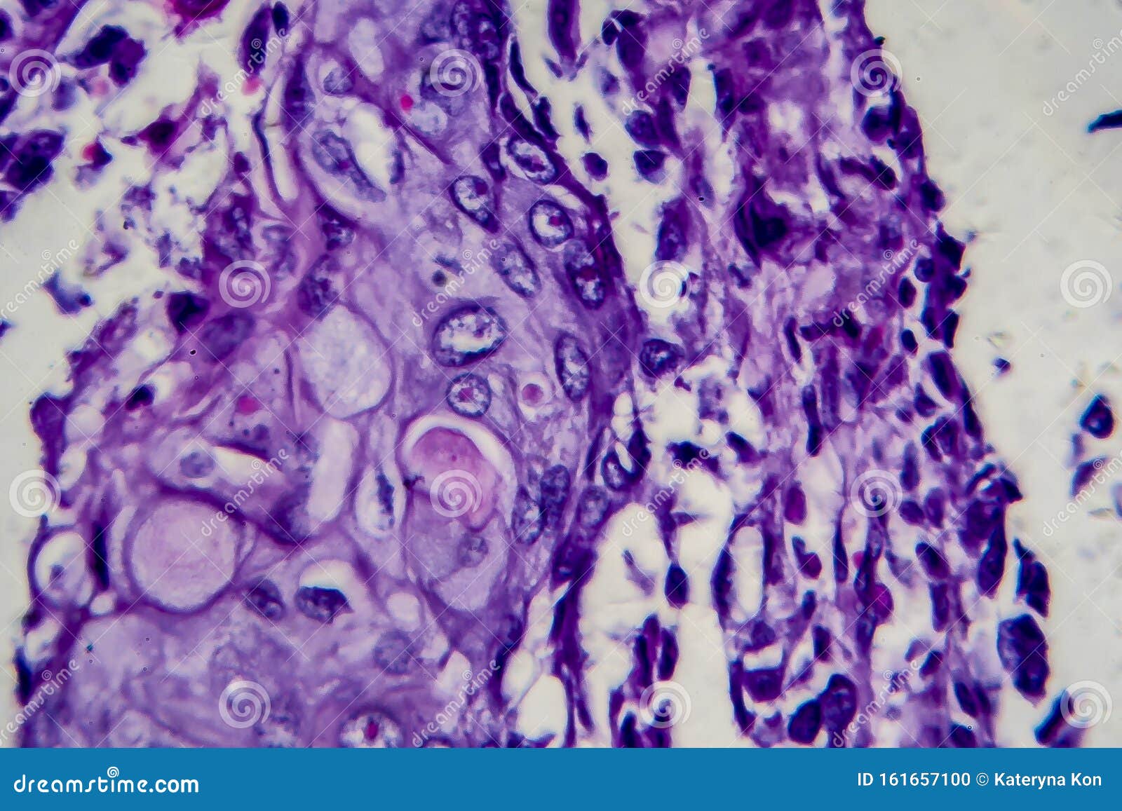 Bladder Transitional Cell Carcinoma, Light Micrograph Stock Image ...