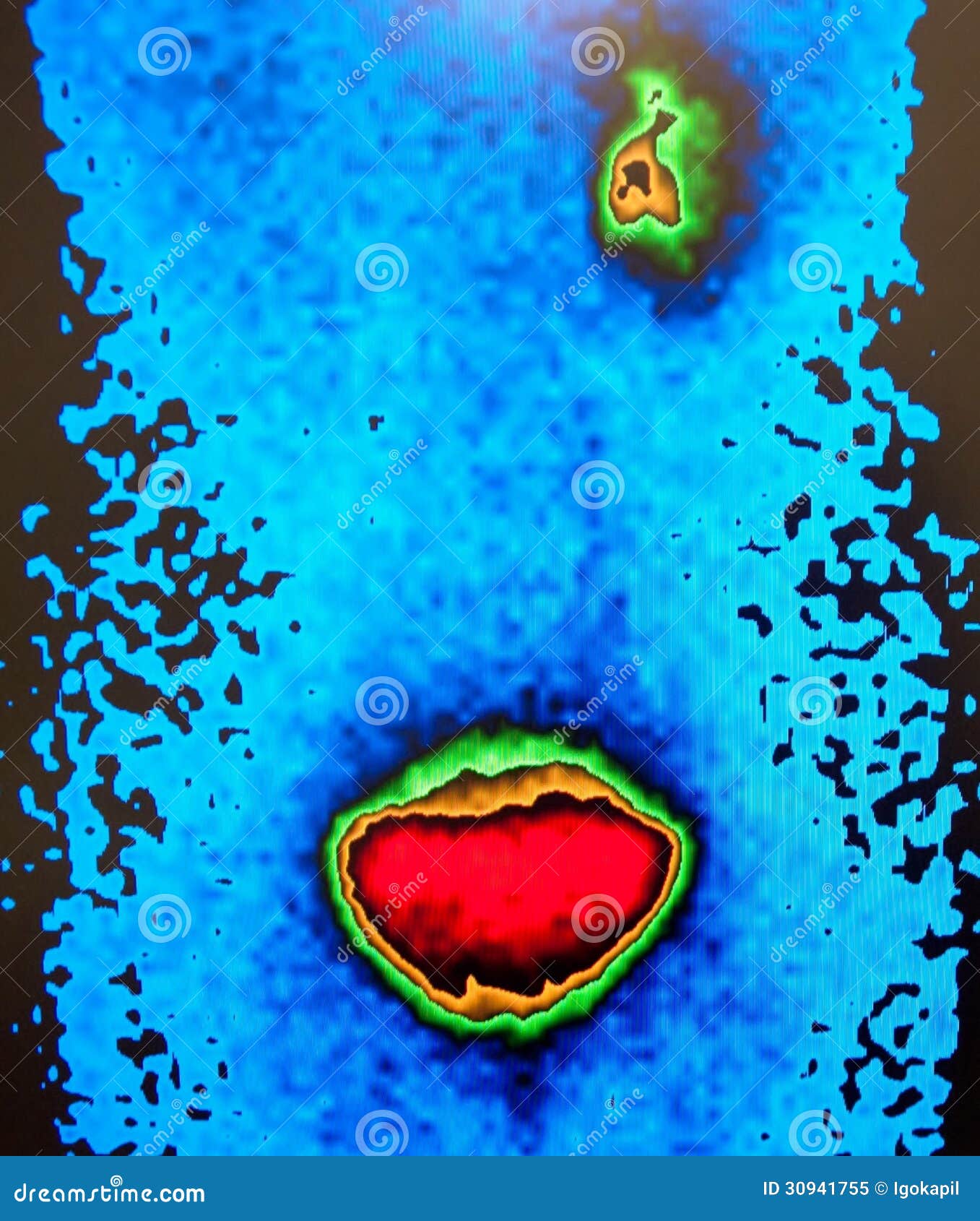 Bladder ,nuclear medicine stock image. Image of disease - 30941755