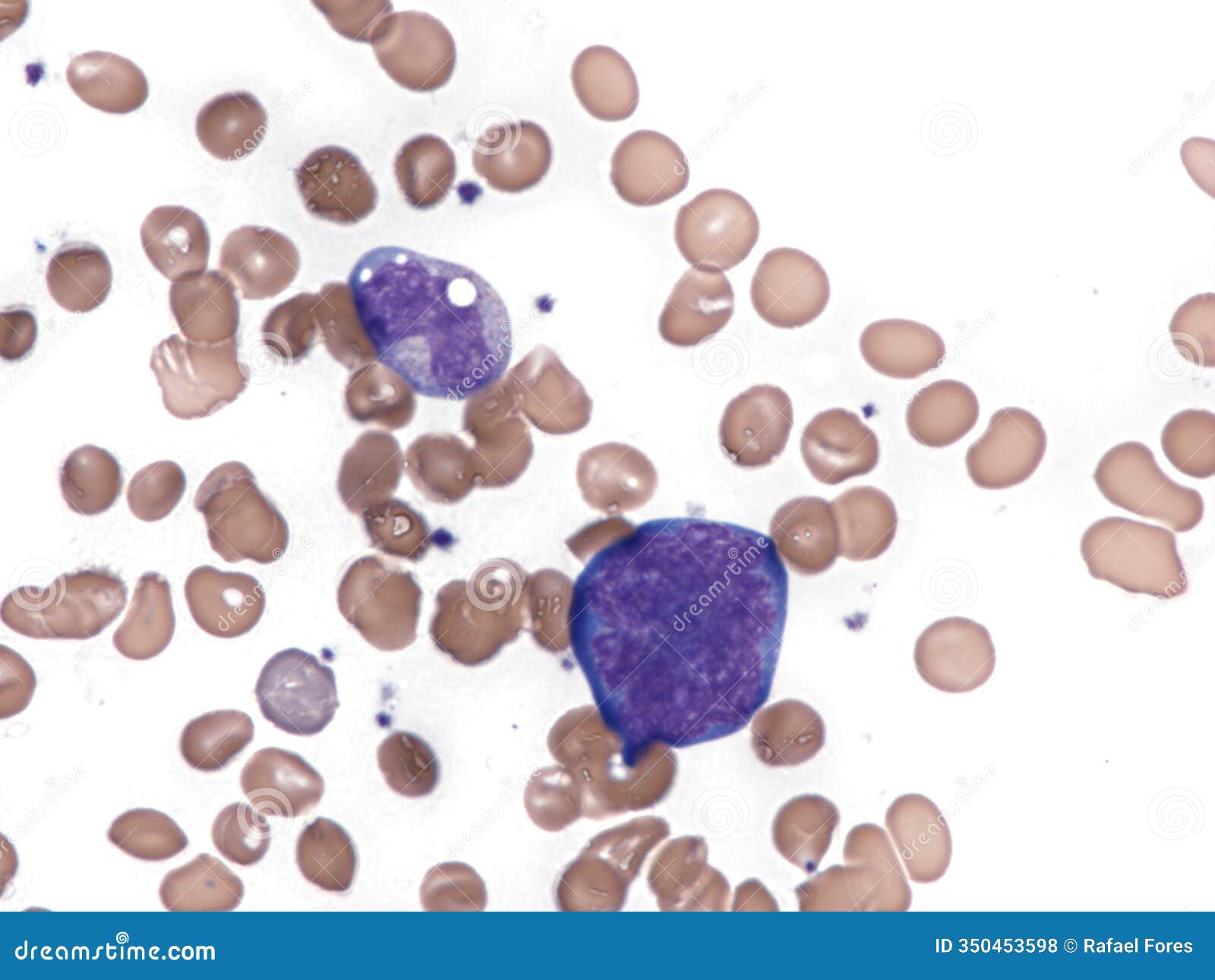 Blast Cell in Acute Myeloid Leukemia. Stock Photo - Image of oncology ...