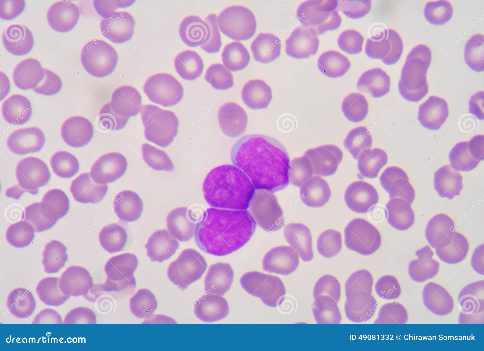 Blast cell stock photo. Image of antigen, granulocyte - 49081332