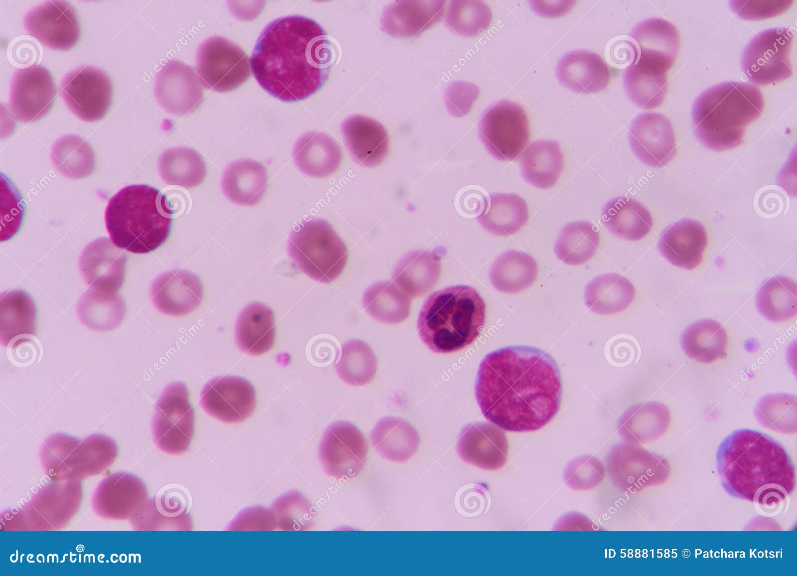 Blast Cell On Blood Smear. Stock Image | CartoonDealer.com #96652987
