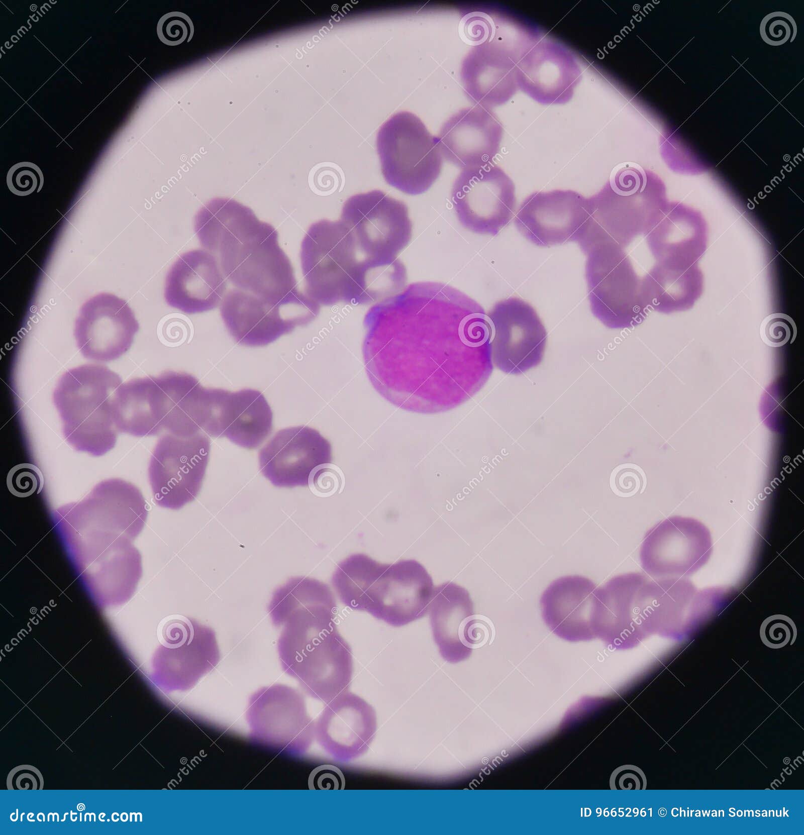 Blast cell on blood smear. stock image. Image of medical - 96652961