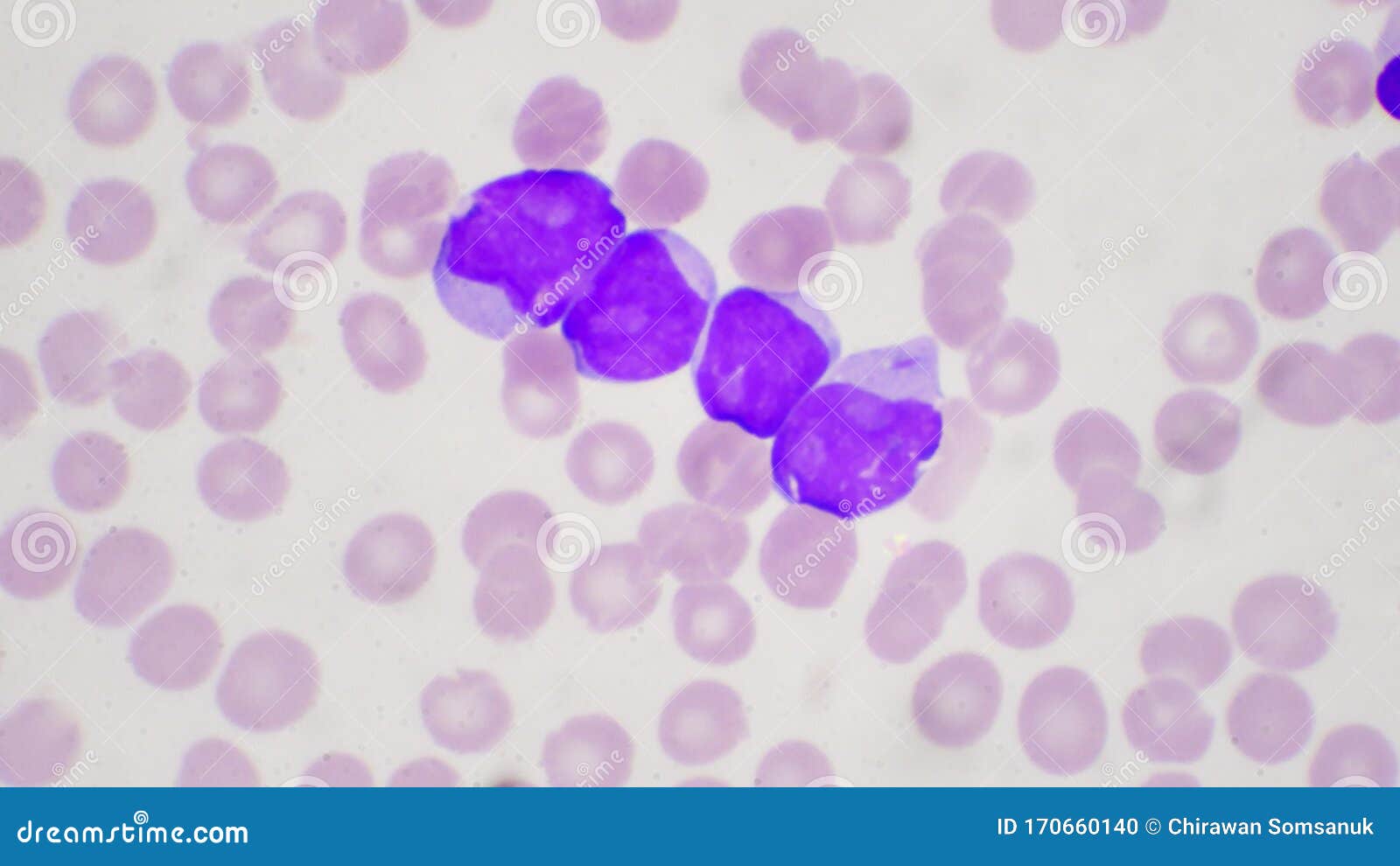 Blast Cell in Leukemia Pateins in Blood Smear Stock Photo - Image of ...