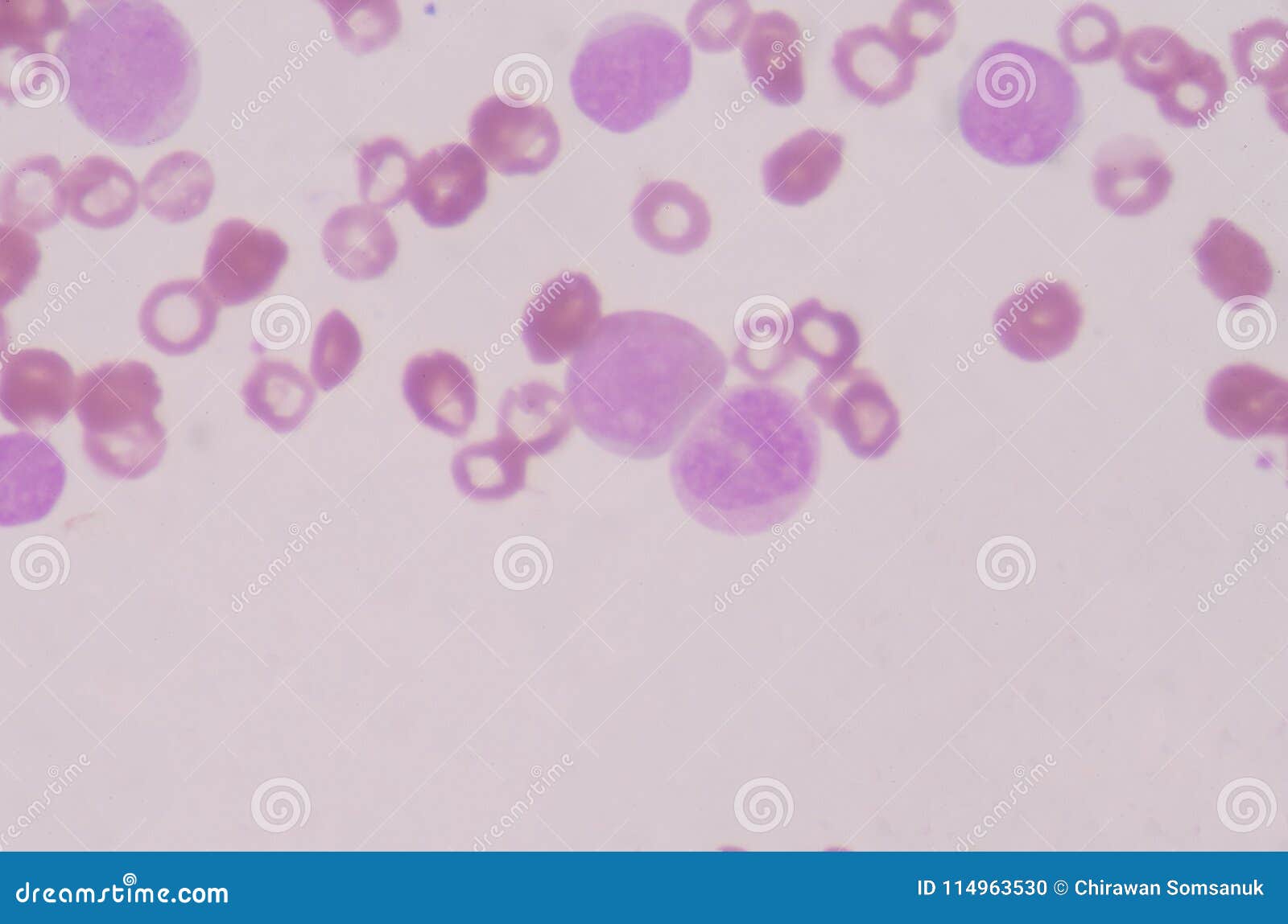Blast Cell with Red Blood Cells. Stock Photo - Image of microscopic ...