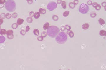Blast Cell with Red Blood Cells. Stock Photo - Image of microscopic ...