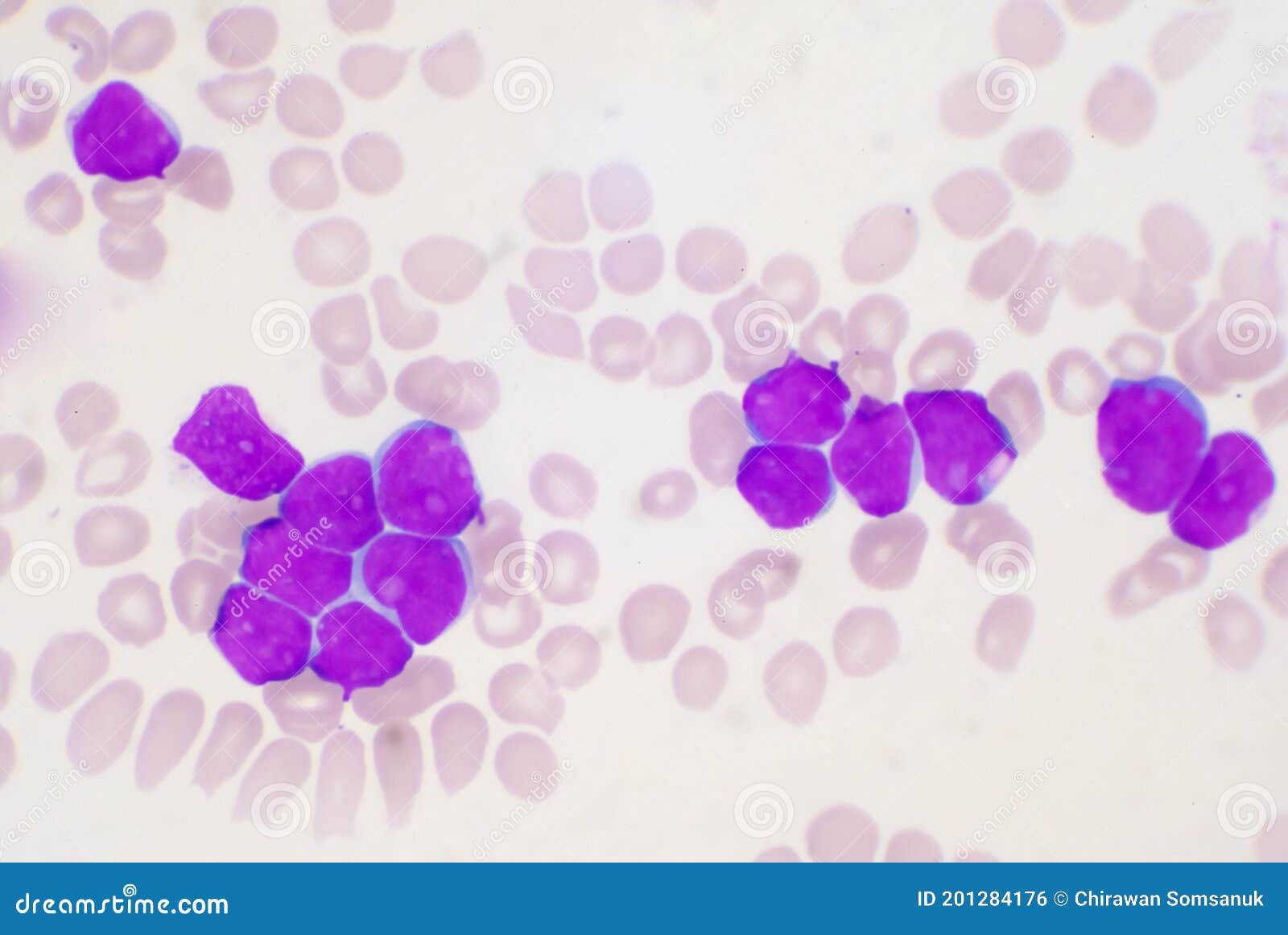 Blast Cell of White Blood Cells in Blood Smear Stock Photo - Image of ...