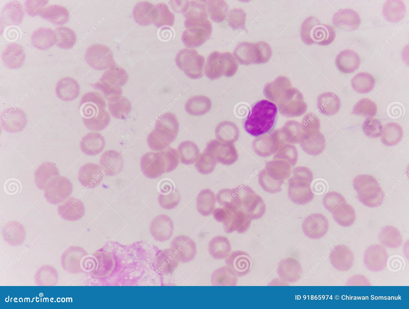 Burst Red Blood Cells Smear