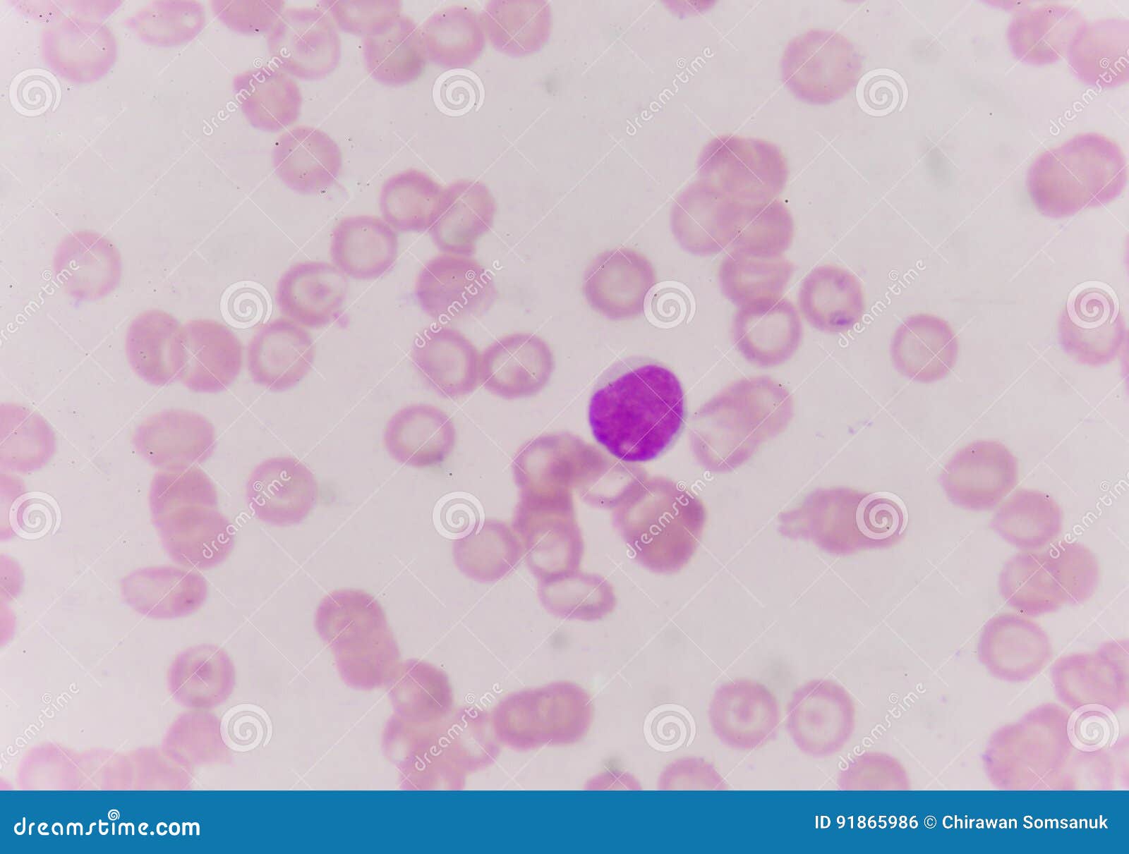 Blast Cells in Blood Smear. Stock Photo - Image of immune, blood: 91865986